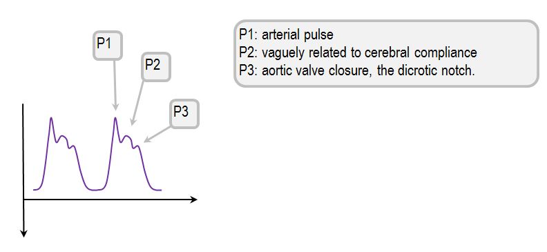Interpretation of intracranial pressure waveforms | Deranged Physiology